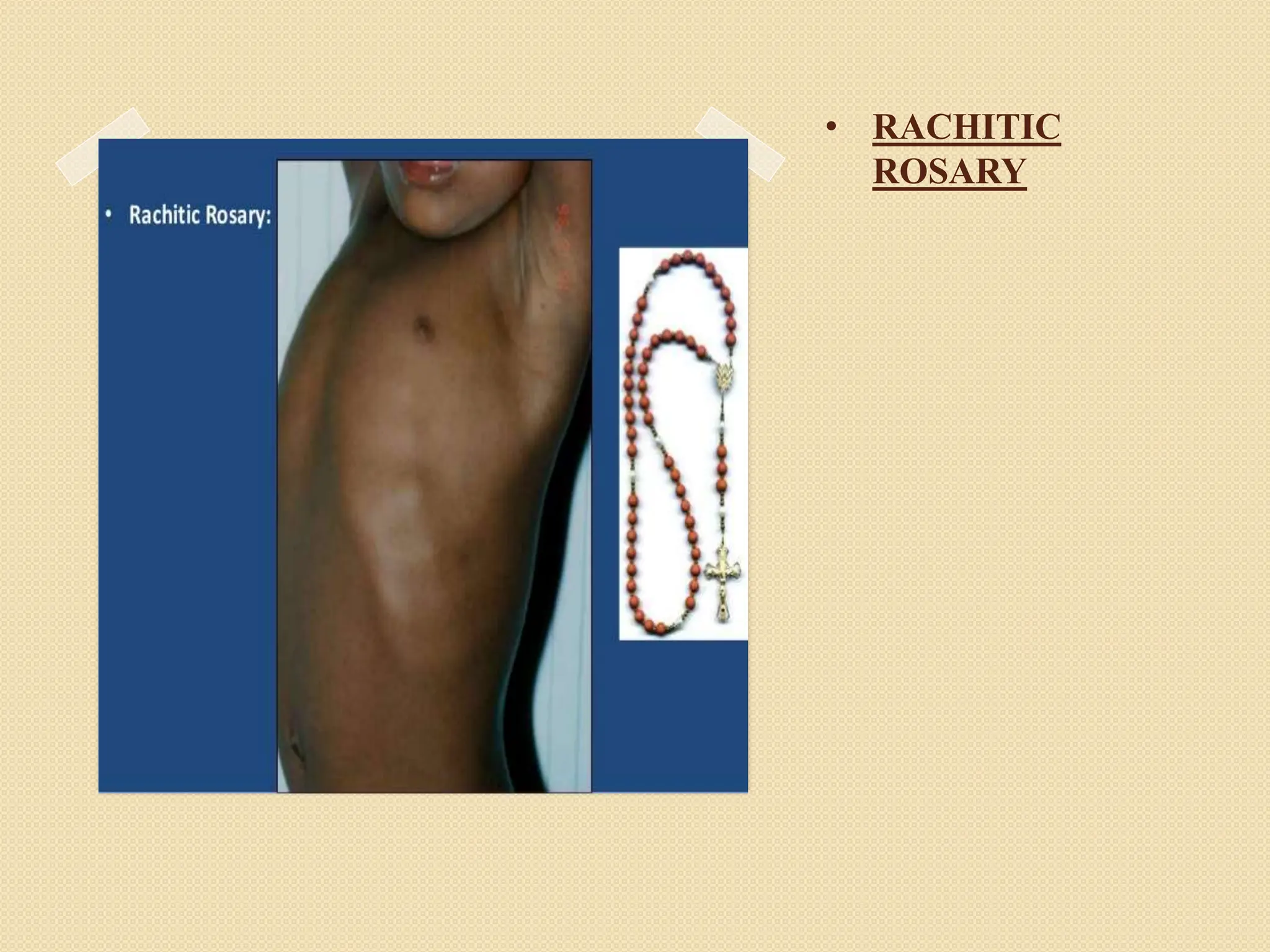 Rickets: a bone softening disease radiologic signs | PPTX