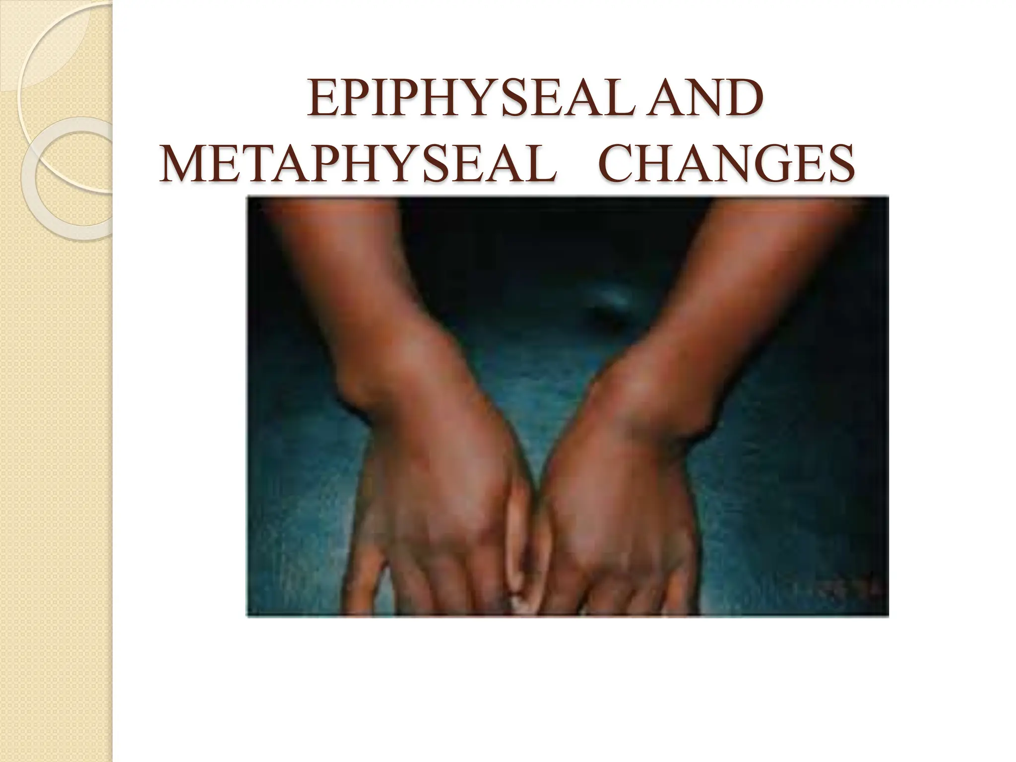 Rickets: a bone softening disease radiologic signs | PPTX