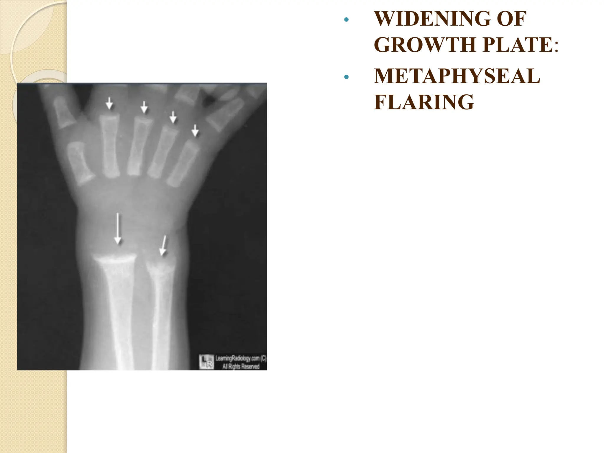 Rickets: a bone softening disease radiologic signs | PPTX