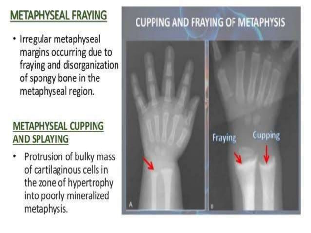 Rickets: a bone softening disease radiologic signs | PPTX | Thyroid ...