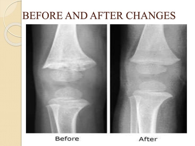 Rickets: a bone softening disease radiologic signs | PPTX | Thyroid ...