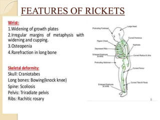 Rickets: a bone softening disease radiologic signs | PPTX
