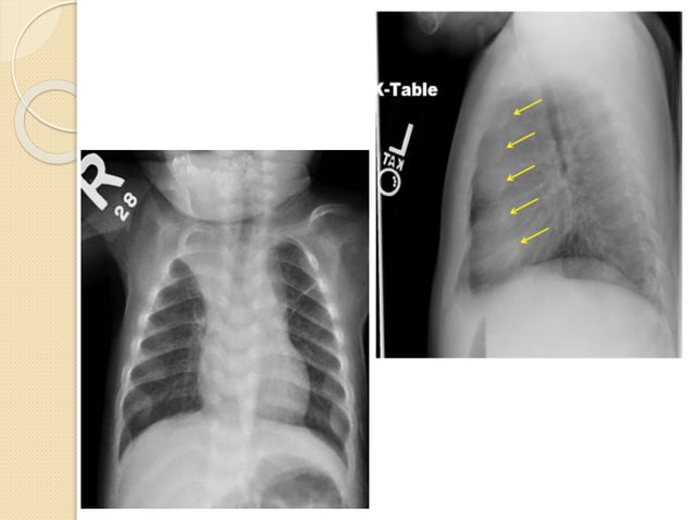 Rickets: a bone softening disease radiologic signs | PPTX | Thyroid ...