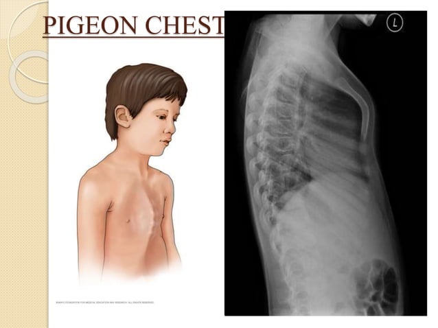 Rickets: a bone softening disease radiologic signs | PPTX | Thyroid ...