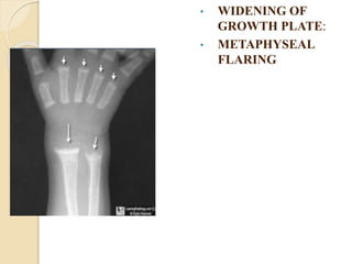 Rickets: a bone softening disease radiologic signs | PPTX