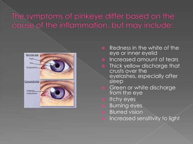 Signs of Pink Eye & its Diagnosis | PPTX