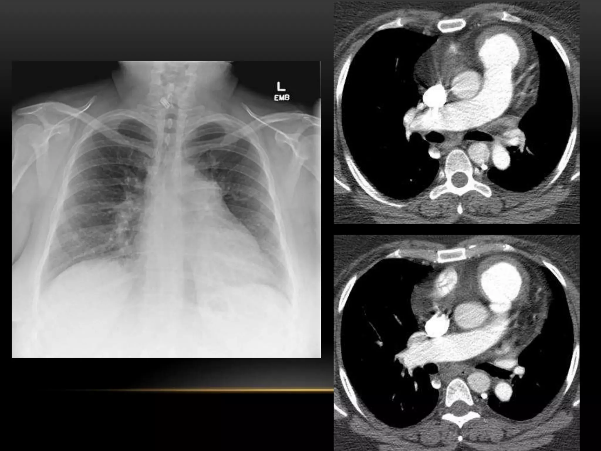 Signs of radiological importance in the thorax Dr.Sumit Sharma | PPTX