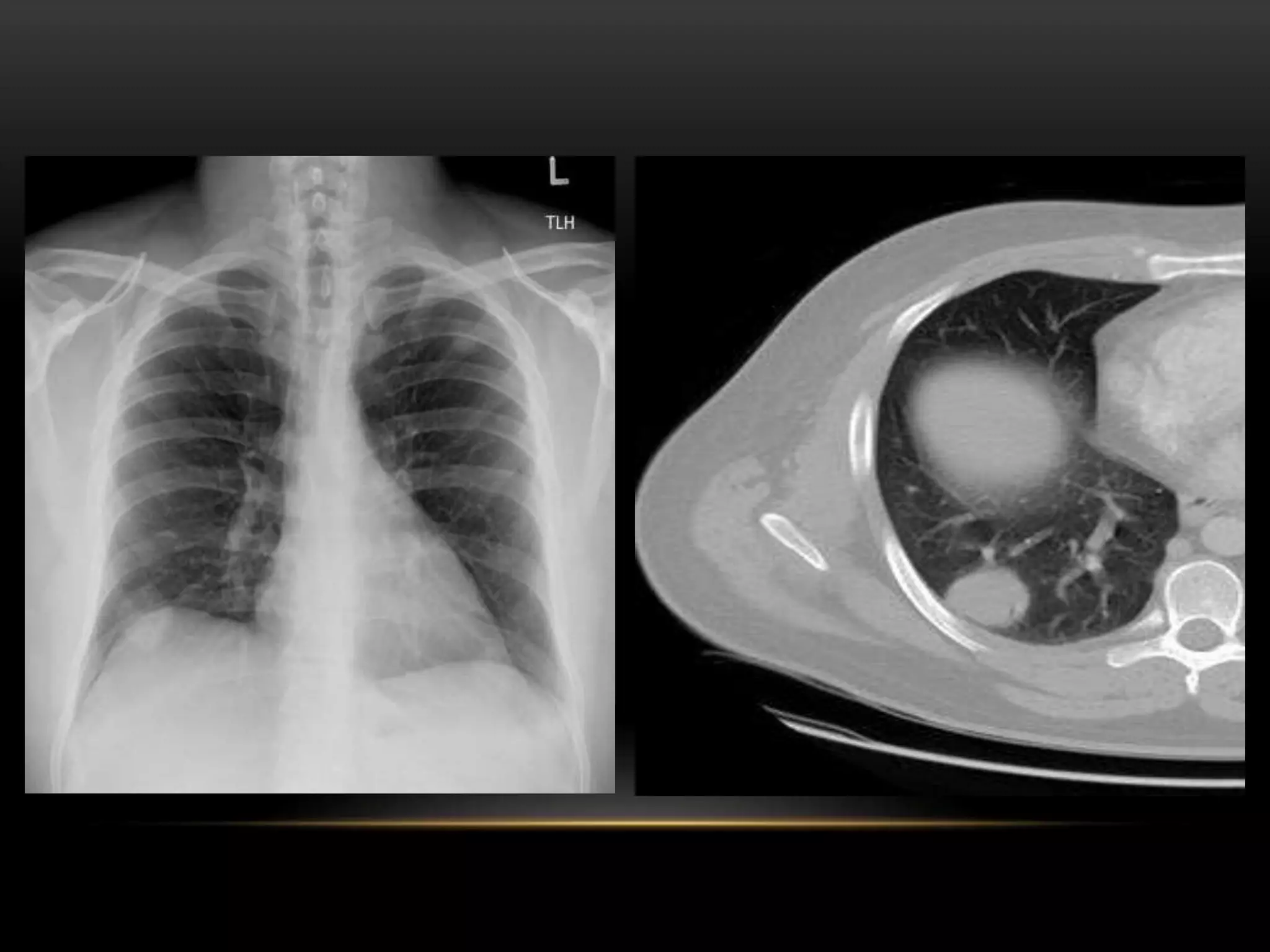 Signs of radiological importance in the thorax Dr.Sumit Sharma | PPTX