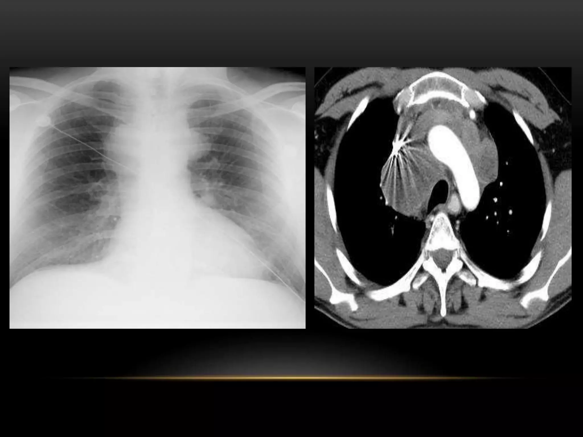 Signs of radiological importance in the thorax Dr.Sumit Sharma | PPTX