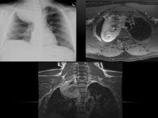 Signs of radiological importance in the thorax Dr.Sumit Sharma | PPTX