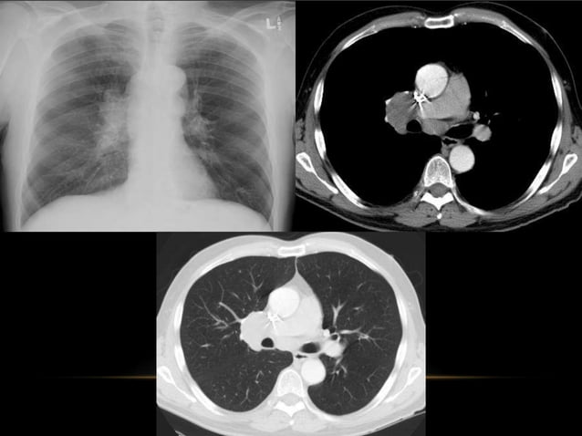 Signs of radiological importance in the thorax Dr.Sumit Sharma | PPTX