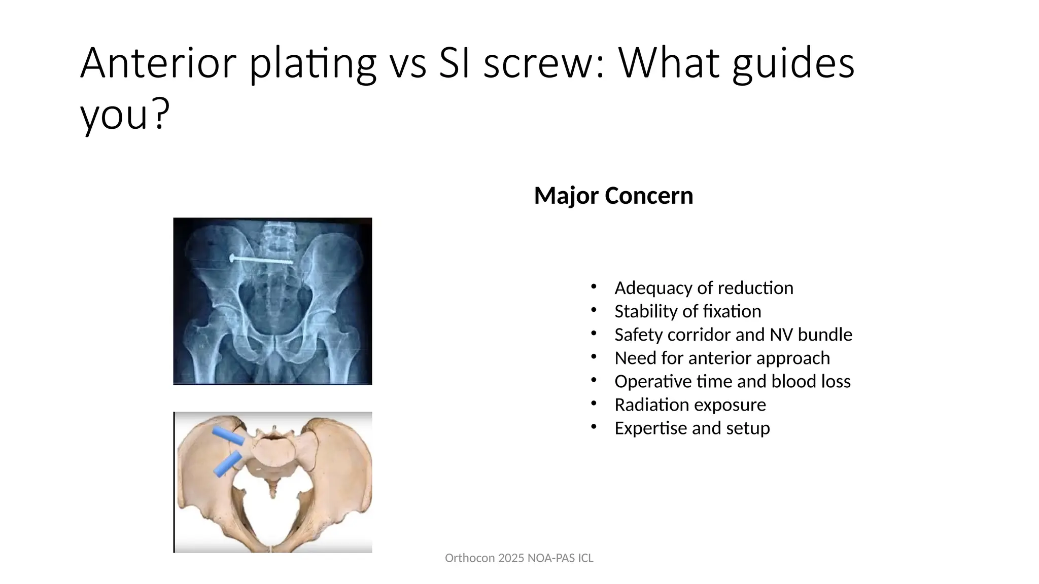 SI joint anterior plating surgical Technique and scopeNOA PAS.pptx