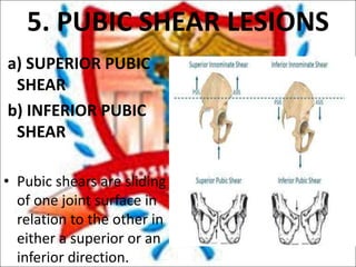 Si joint dysfunction | PPT