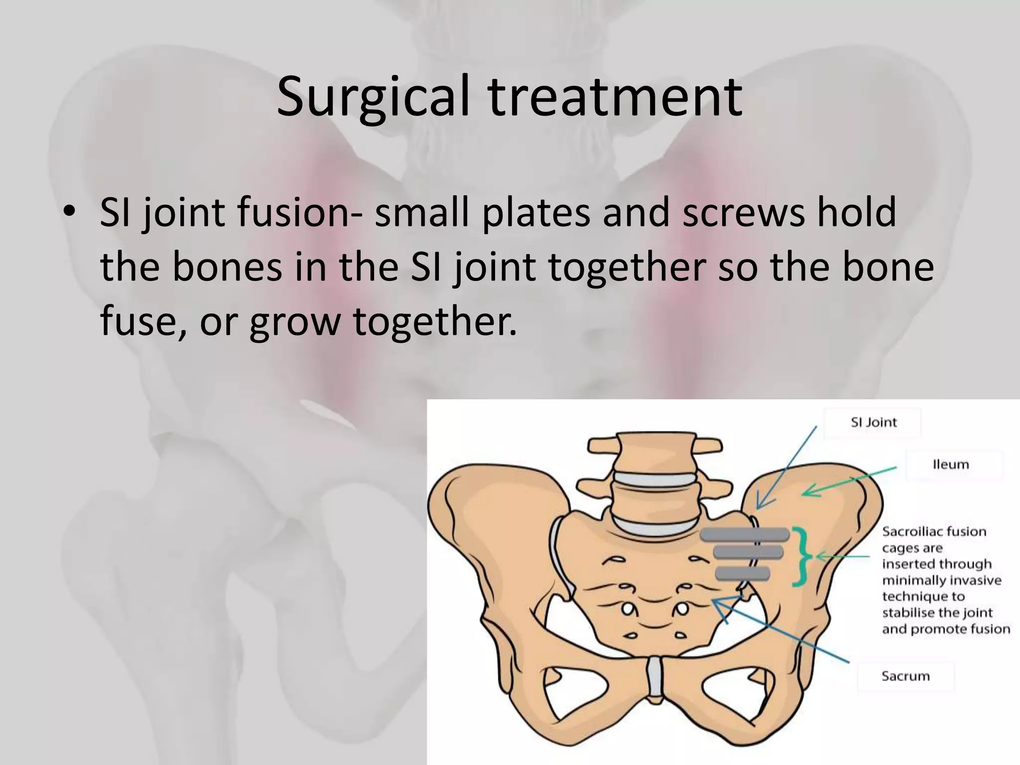 SI JOINT DYSFUNCTION.pptx
