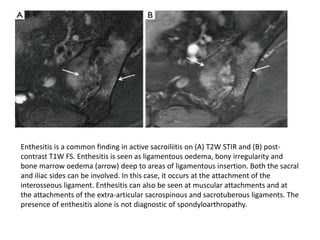 SI JOINT PATHOLOGIES.pptx