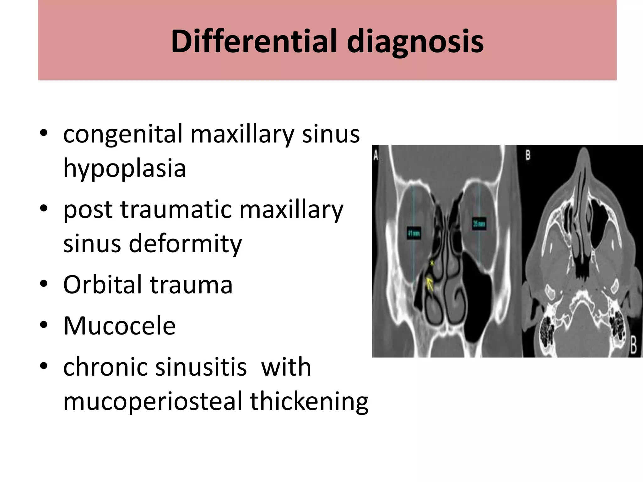Silent sinus syndrome-In the eye of a Radiologist | PPTX