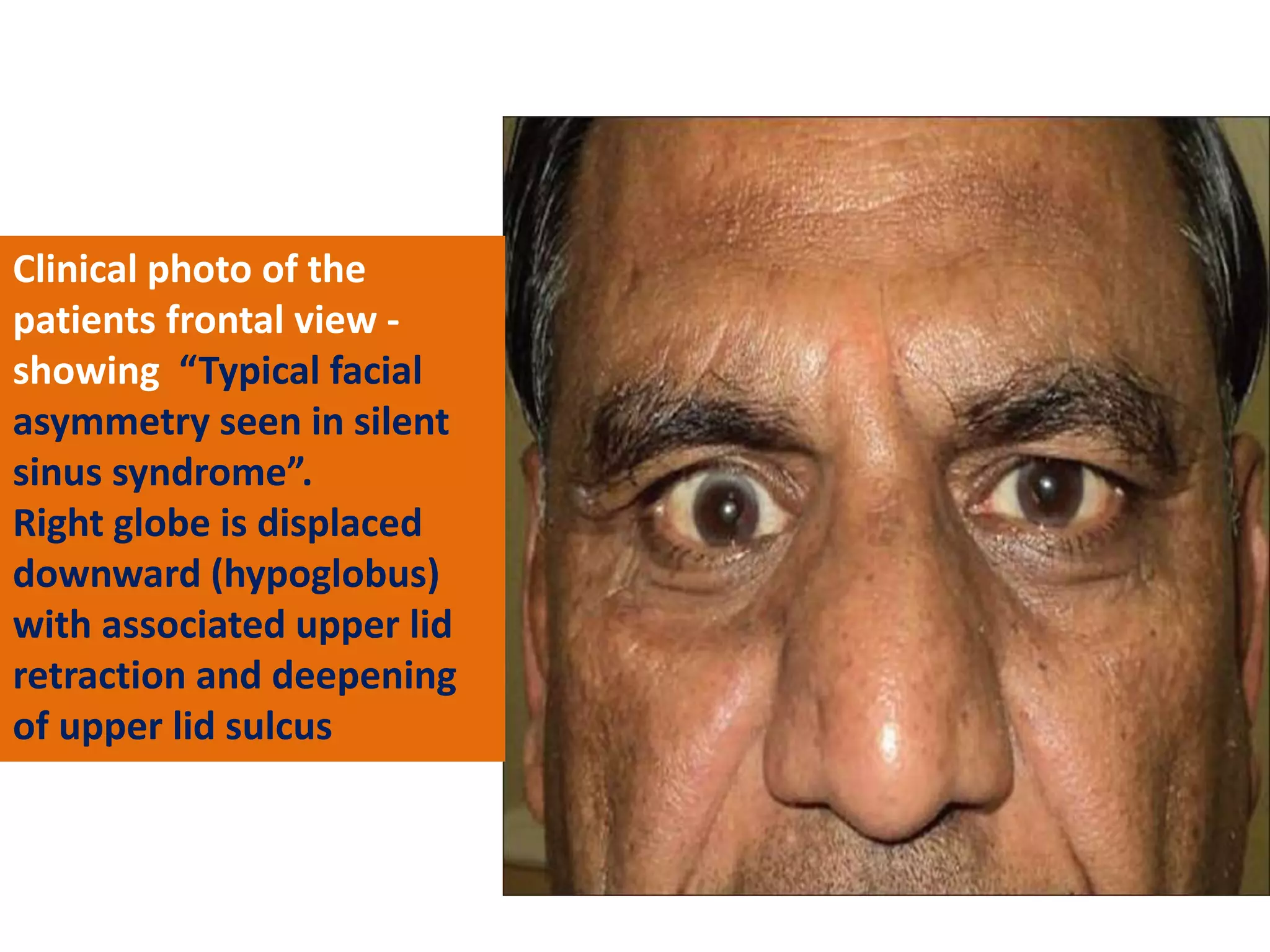 Silent sinus syndrome-In the eye of a Radiologist | PPTX