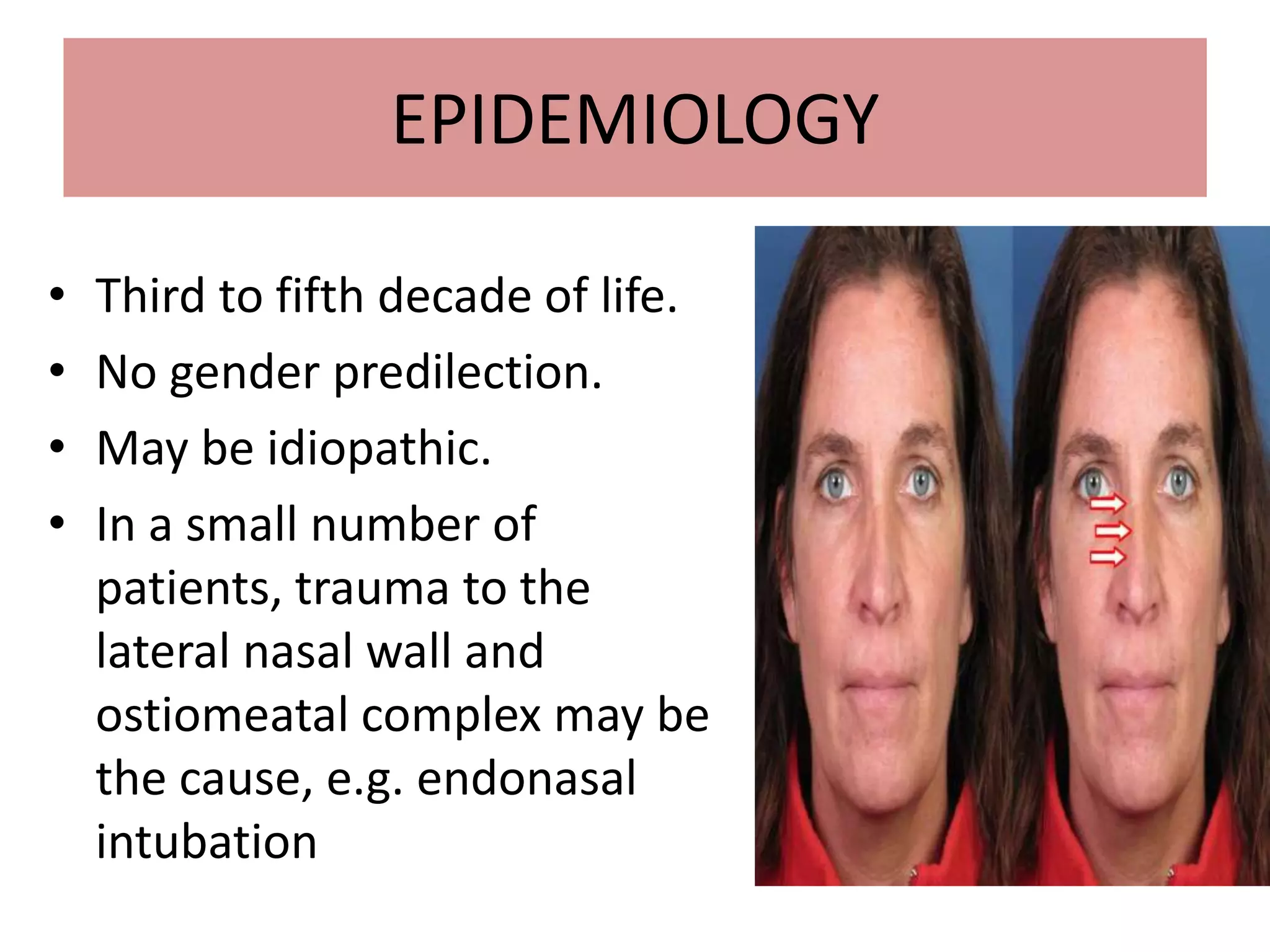 Silent sinus syndrome-In the eye of a Radiologist | PPTX