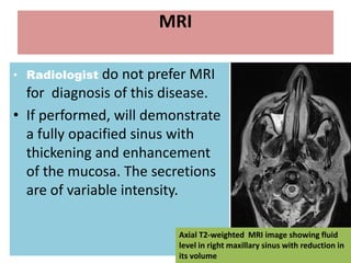 Silent sinus syndrome-In the eye of a Radiologist | PPTX