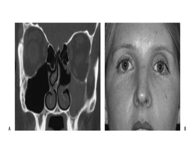 Silent sinus syndrome-In the eye of a Radiologist | PPTX