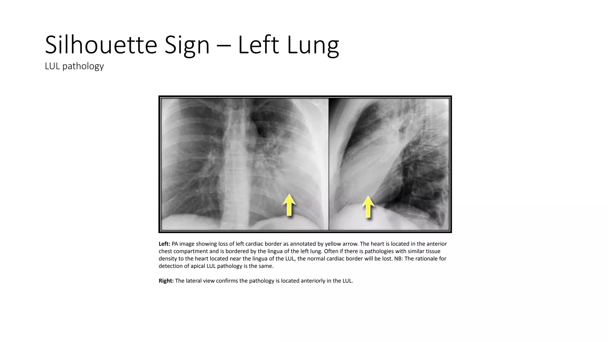 Silhouette Sign left lung | PPTX