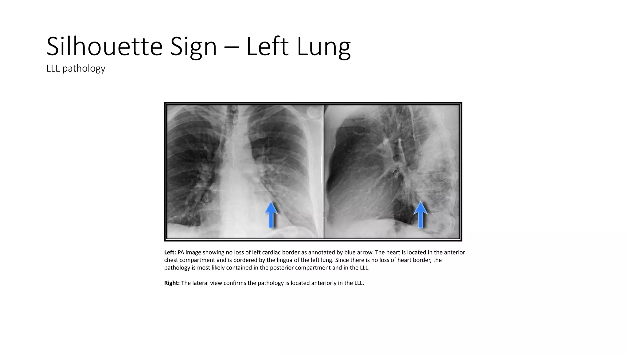 Silhouette Sign left lung | PPTX