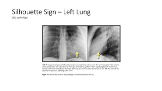 Silhouette Sign left lung | PPTX