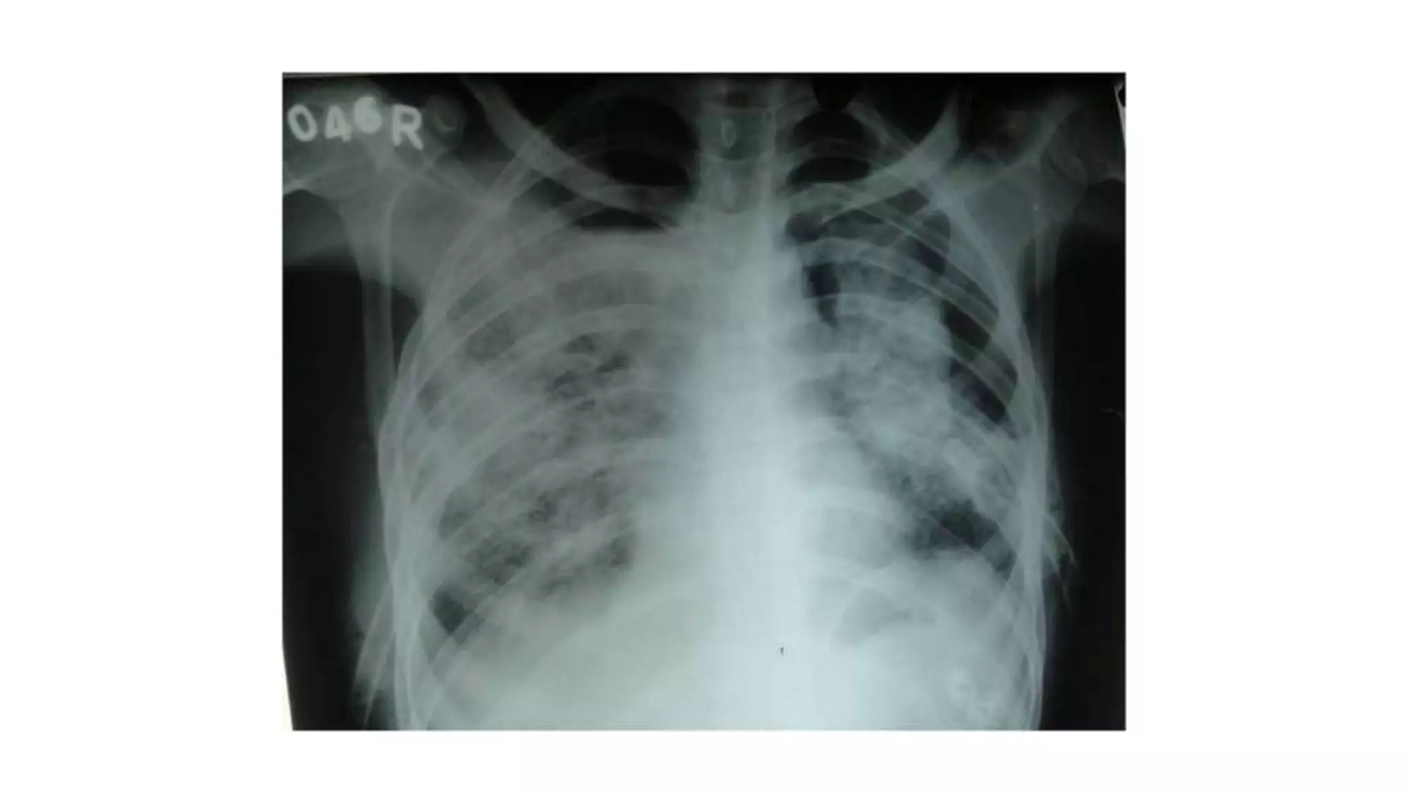 silicosis.pptx | Lung and Respiratory Health | Diseases and Conditions