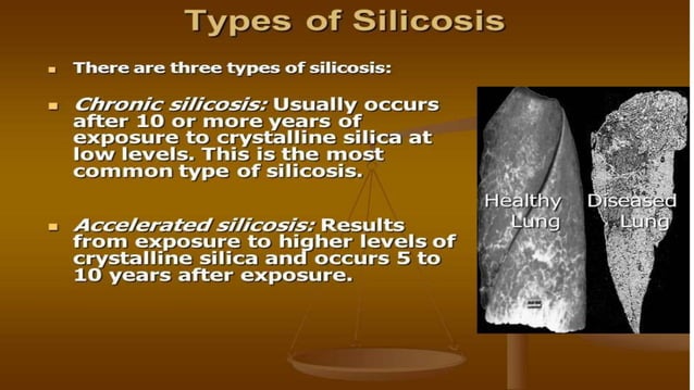 SILICOSIS.pptx [medical surgical Nursing] | PPTX