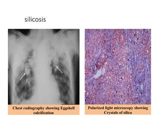 Occupational lung disease - Silicosis.pptx