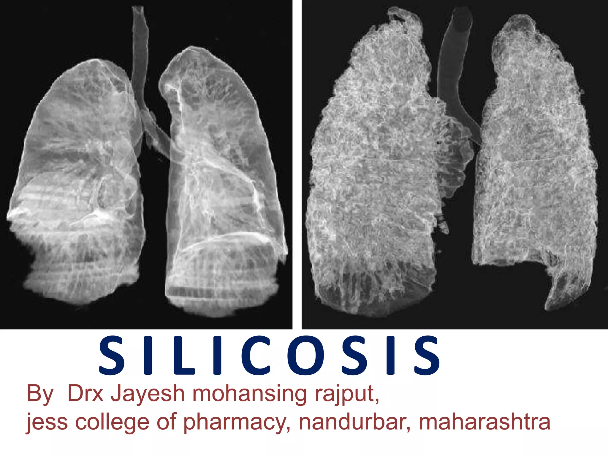 Silicosis by jayesh rajput | PPT