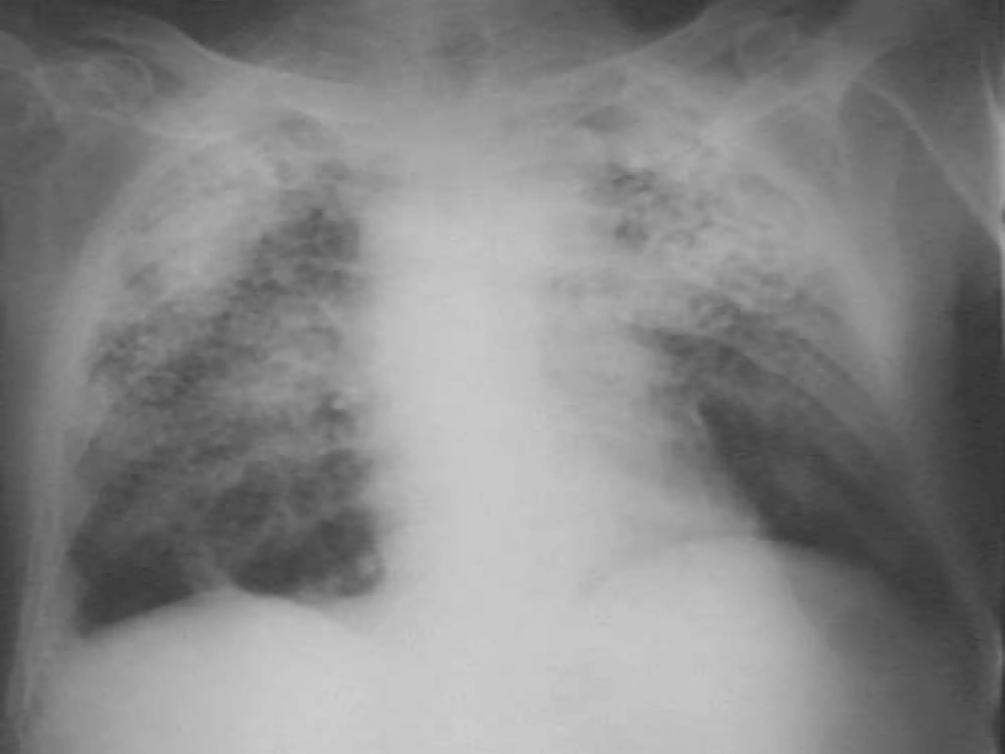 Silicosis by jayesh rajput | PPT