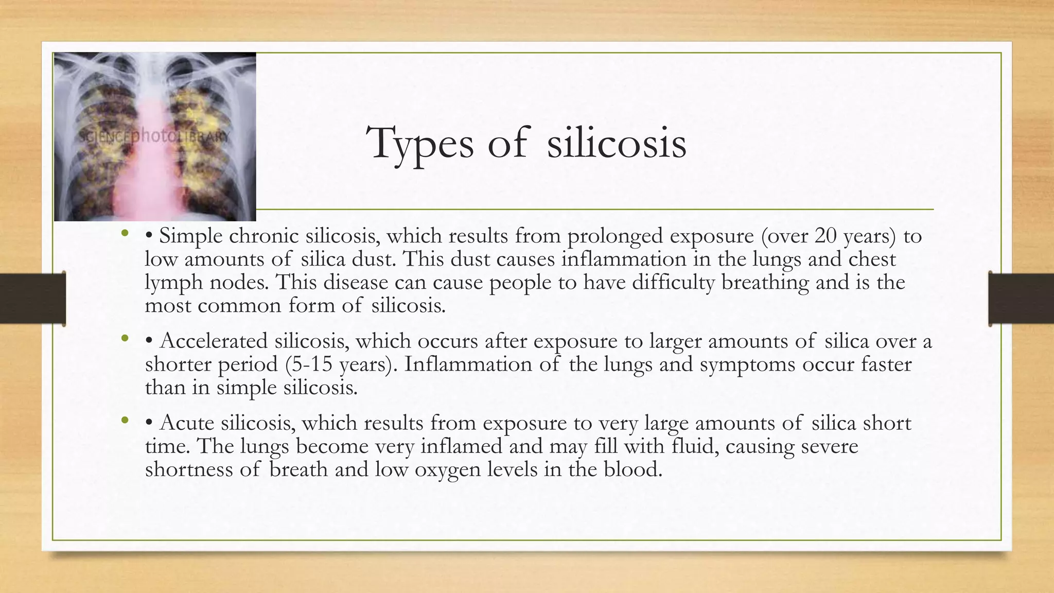 Silicosis in miners hidalgo | PPSX