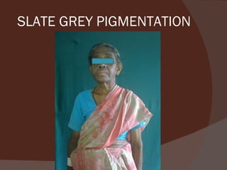 CXR: Silico-Tuberculosis | PPT