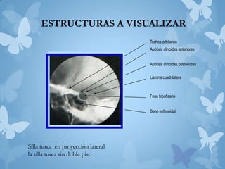 Silla turca | PPTX