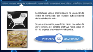 Síndrome de la silla turca: diagnóstico y manejo | PPTX