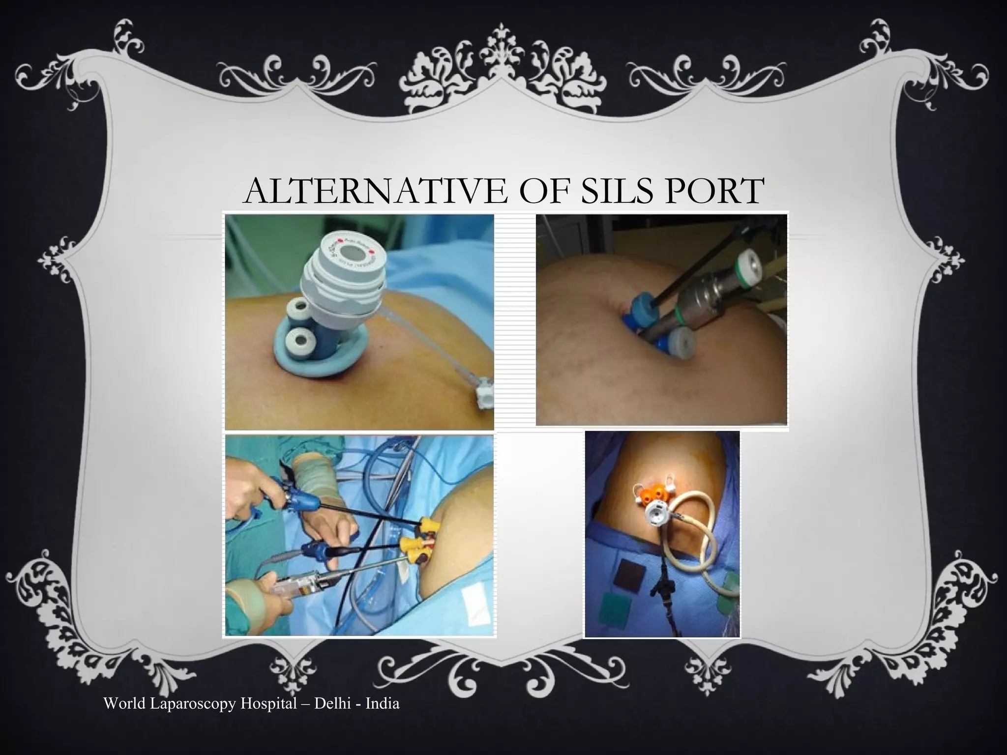 Single incision laparoscopic Surgery-SILS | PPT