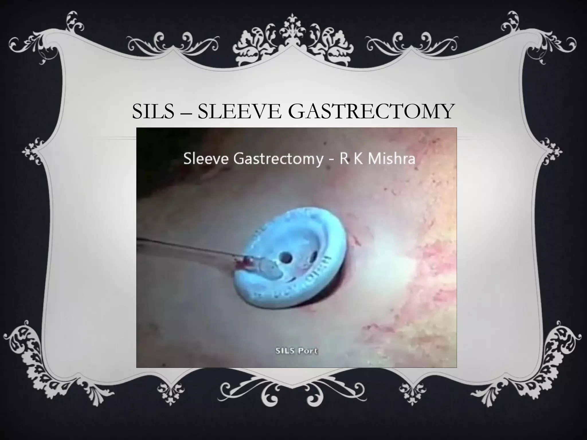 Single incision laparoscopic Surgery-SILS | PPT