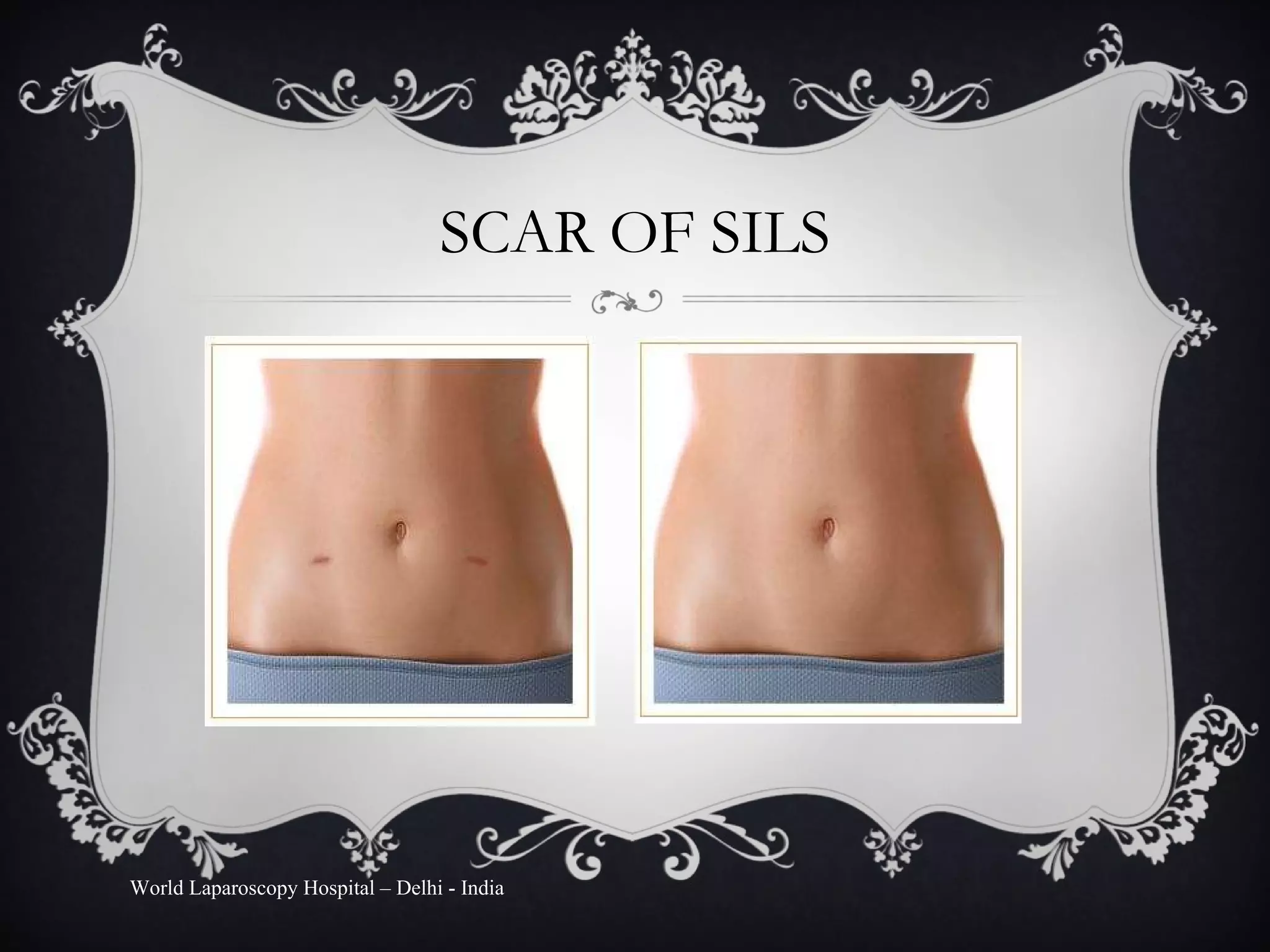 Single incision laparoscopic Surgery-SILS | PPT