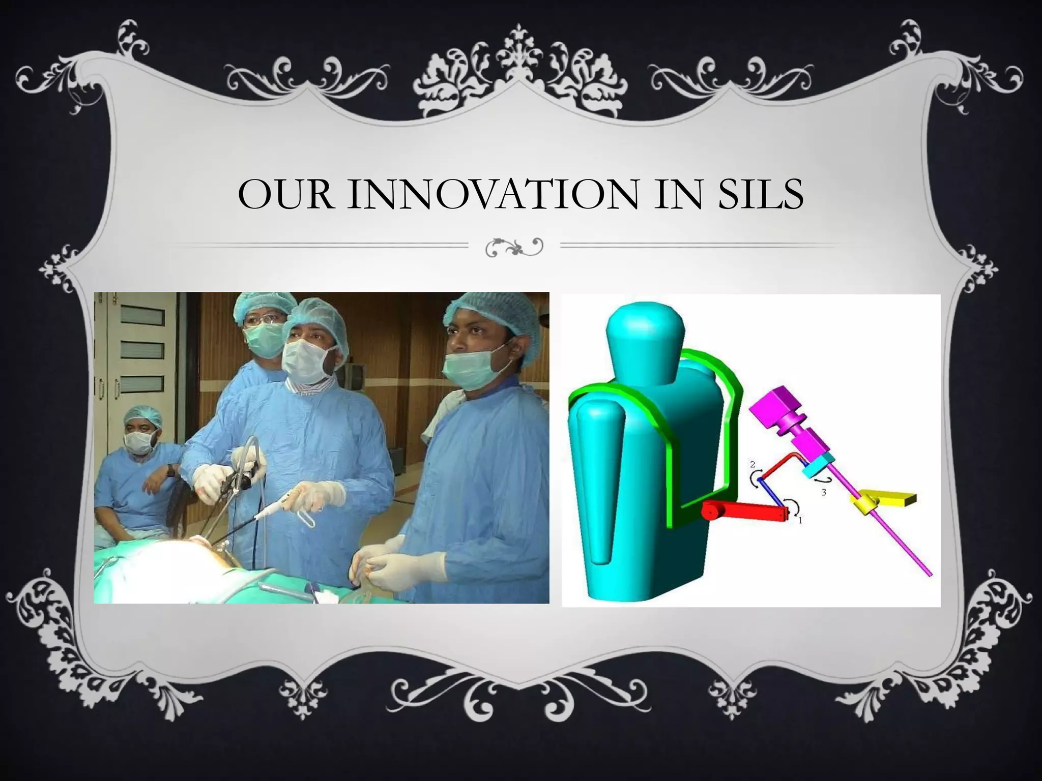 Single incision laparoscopic Surgery-SILS | PPT