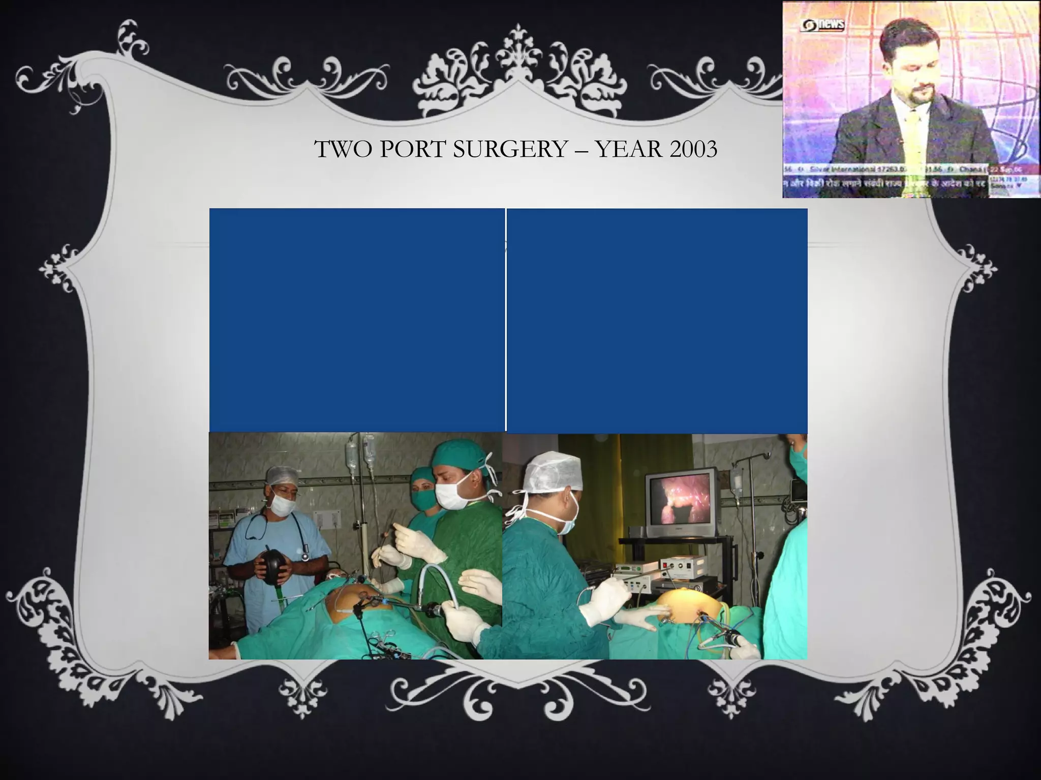 Single incision laparoscopic Surgery-SILS | PPT