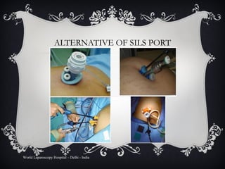 Single incision laparoscopic Surgery-SILS | PPT