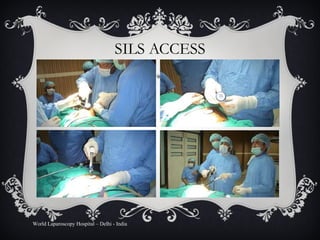 Single incision laparoscopic Surgery-SILS | PPT