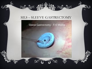 Single incision laparoscopic Surgery-SILS | PPT