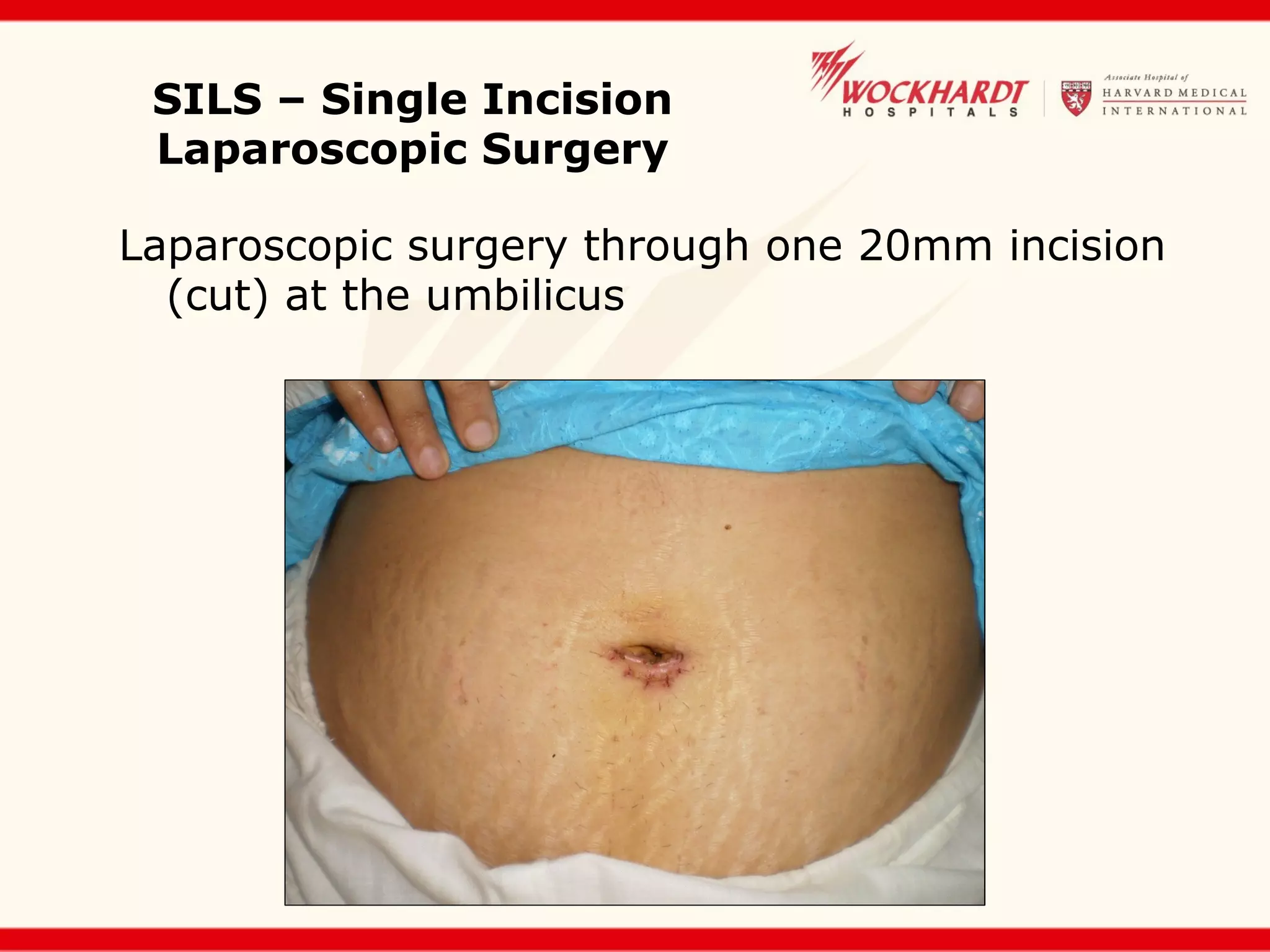 Single Incision Laparoscopic Surgery | PPT