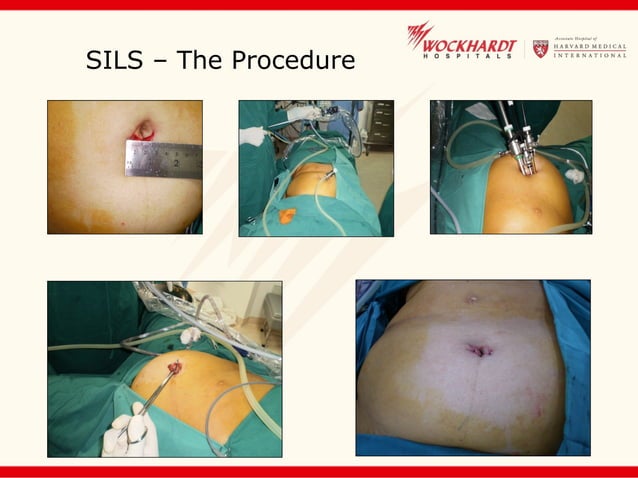 Single Incision Laparoscopic Surgery | PPT | Digestive Disorders ...