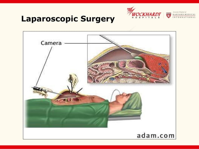 Single Incision Laparoscopic Surgery | PPT | Digestive Disorders ...