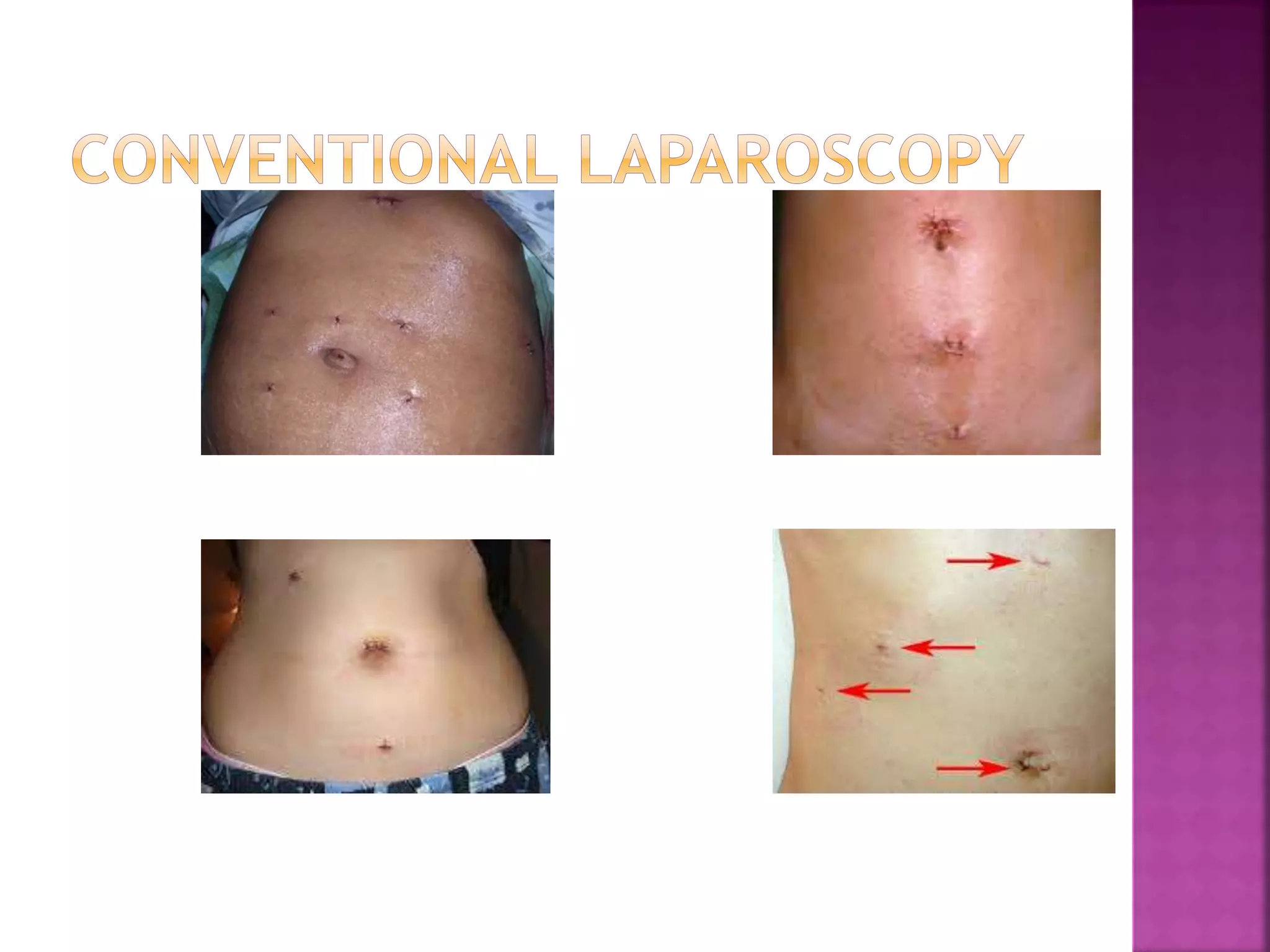 SILS - SINGLE INCISION LAPAROSCOPIC SURGERY | PPTX