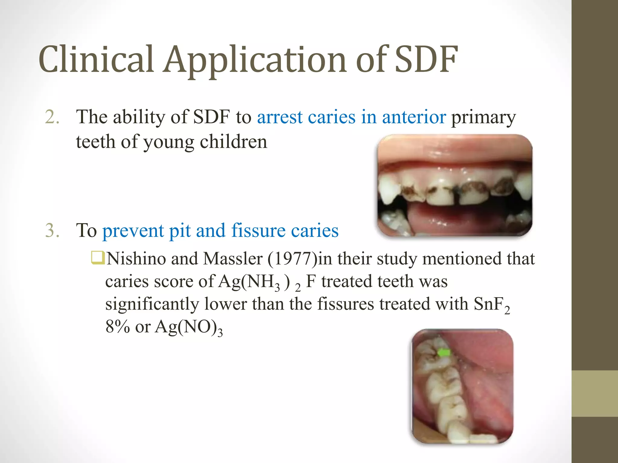 Silver diamine flouride | PPTX