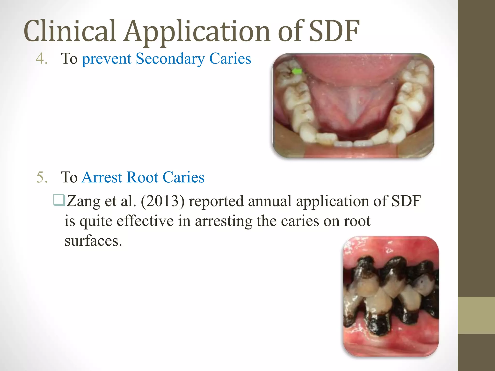 Silver diamine flouride | PPTX